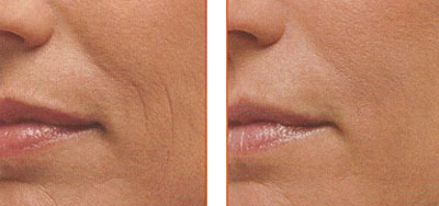 Argireline Matrixyl 3000 Hyaluronic Acid Peptide Serum Wrinkle Collagen ...